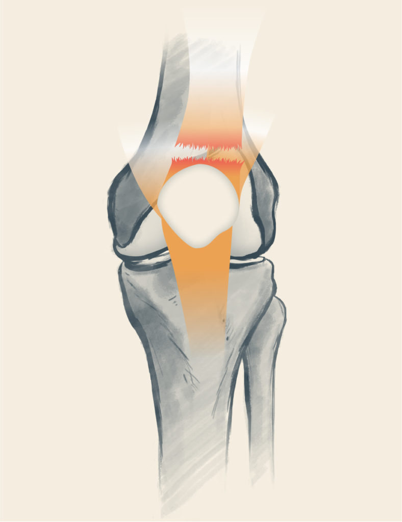 Knee extensor mechanism: structure, traumas and interventions - Centre ...