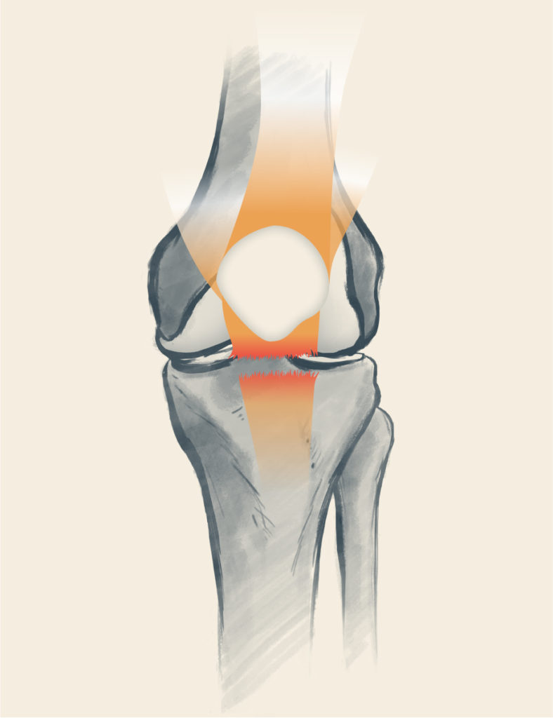 Knee extensor mechanism: structure, traumas and interventions - Centre ...