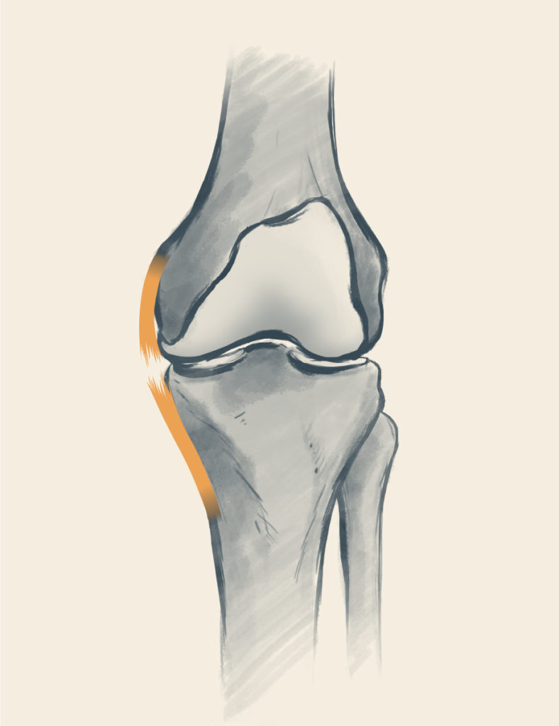 Ligaments (croisés, collatéraux) - Centre du Genou Genève